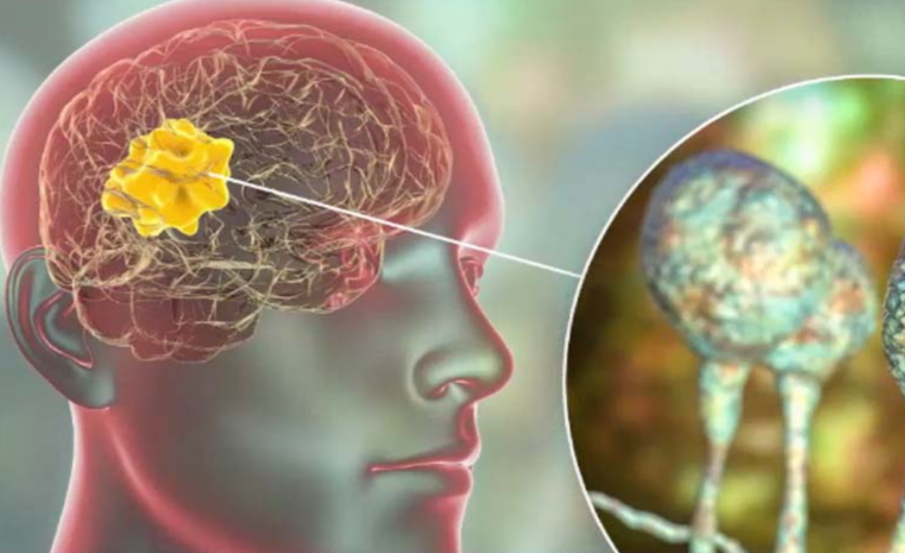 Todo lo que tienes que saber sobre el Hongo Negro - Mujer es Más